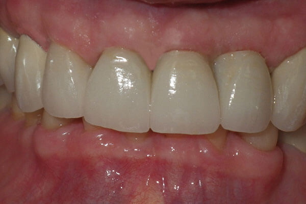 Single Tooth Dental Implant | Scarsdale Dental Group Single Tooth Dental Implant | Scarsdale Dental Group