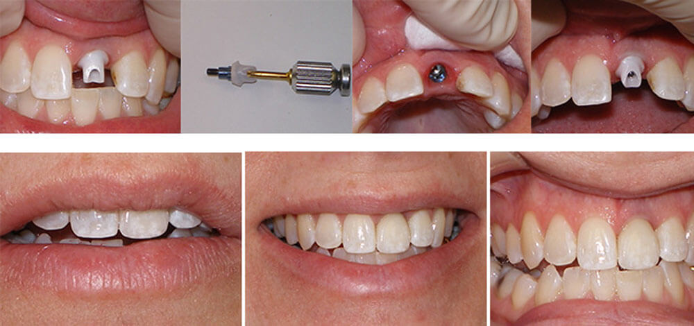 Single Tooth Dental Implant | Scarsdale Dental Group Single Tooth Dental Implant | Scarsdale Dental Group